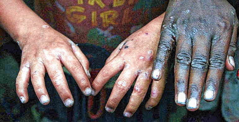 Massive skin disease affected many villagers at Raninagar due to Panga ...