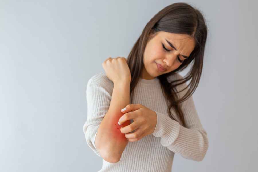 Eczema Symptoms | Top ways to manage an eczema flare dgtl - Anandabazar